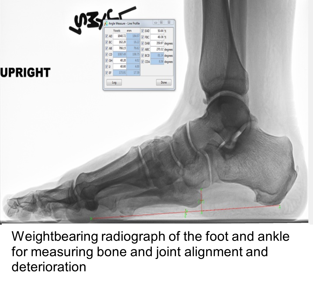 Foot & Ankle Injury & Recovery - Program in Physical Therapy